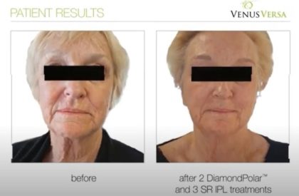 Venus Versa Anti-Ageing Treatments Hertfordshire Skin Clinic